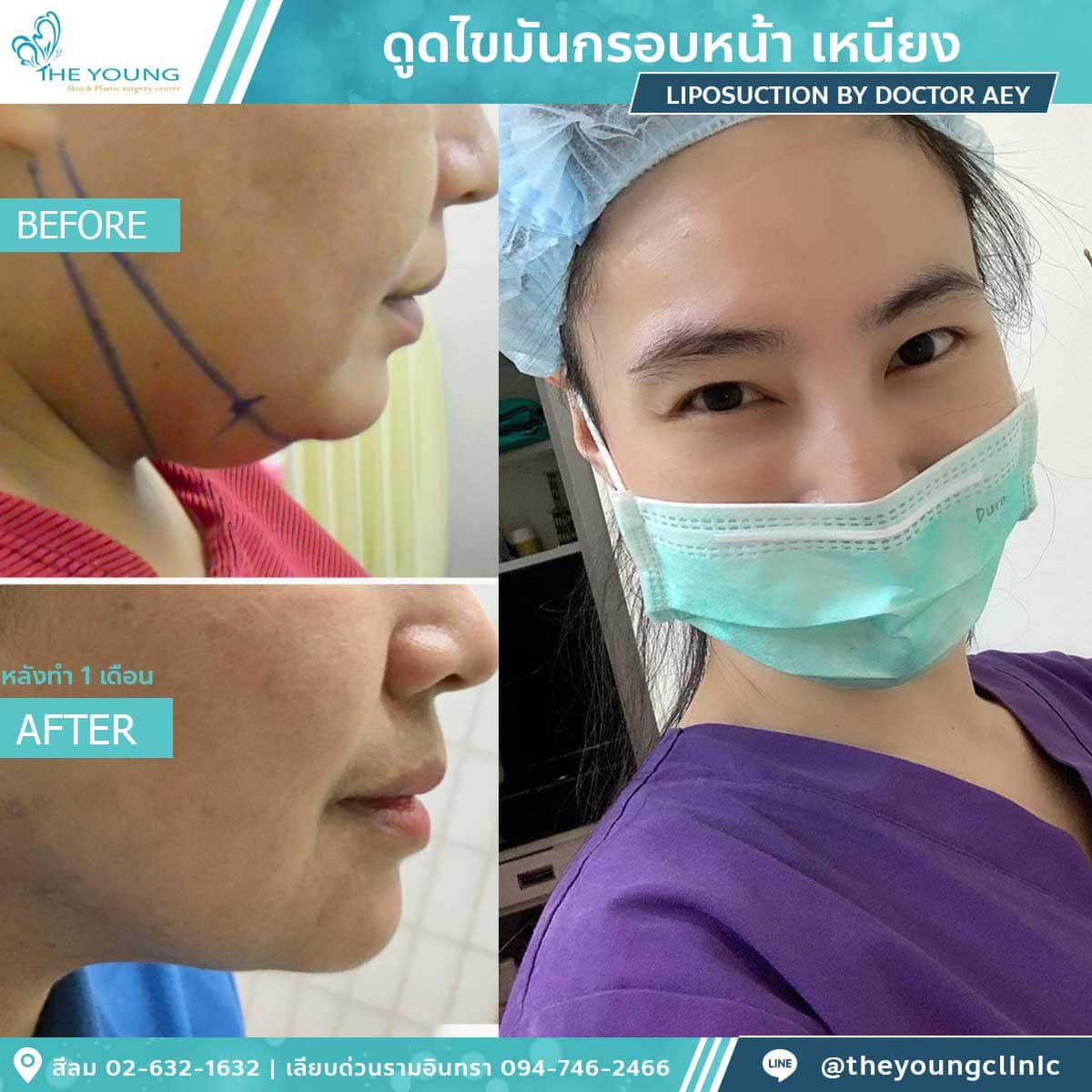 ดูดไขมันเหนียง Double Chin Liposuction - The Young Clinic